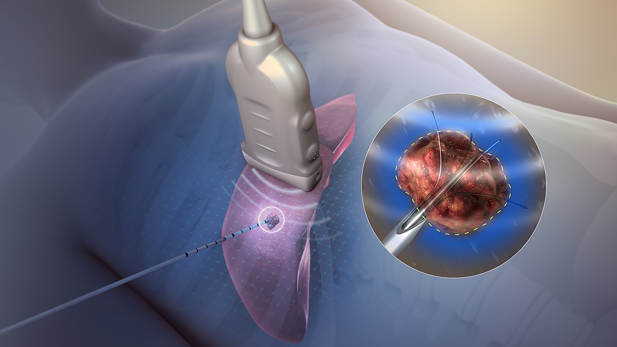 Radiofrequency Ablation (RFA): A Guide – ALBGTC Med